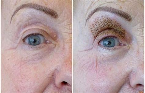 Fibroblast Skin Tightening Removing Excess Skin Volume