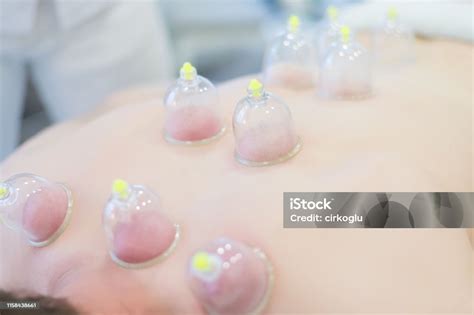 마사지 테이블에 누워 젊은 남자의 닫고 히자마 치료를 위해 준비 Hajamat에 대한 스톡 사진 및 기타 이미지 Hajamat 고대의 남자 Istock