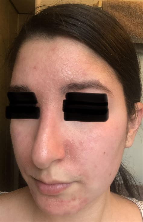 Diagnosed With Rosacea In April And Have Been On 40mg Doxycycline And
