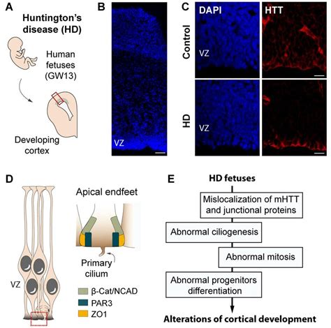 abnormalities of human cortical development in huntington s disease