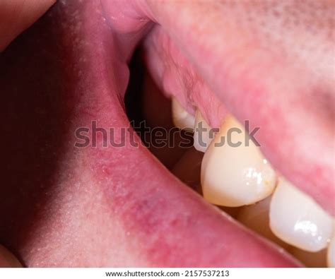 Dissection Decayed Teeth Installation Dental Crown库存照片2157537213