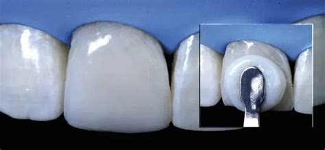Direct Composite Veneers A Guide To Layering And Preparation
