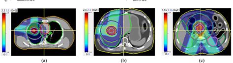 Figure 3 From Dosimetric Impact Of Geometric Distortions In An Mri Only Proton Therapy Workflow