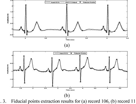 Figure 1 From Model Based Ecg Fiducial Points Extraction Using A