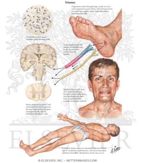 Tetanus Causes Symptoms Treatment Tetanus Causes