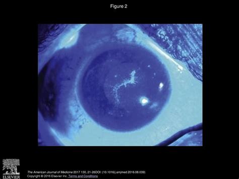 Herpes Zoster Ophthalmicus A Review For The Internist Ppt Download