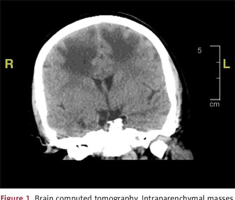 Figure 1 From A Case Of Synchronous Primary Tumors Of The Left Ovary And Uterus Semantic Scholar