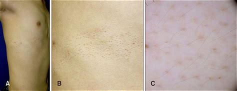 Unilateral Linear Keratosis Pilaris On Hypopigmented Patches An
