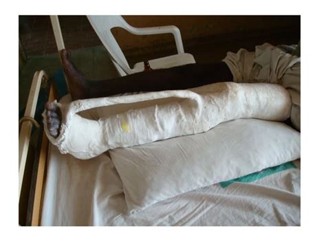 Traction And Splints In Orthopaedics New Ppt