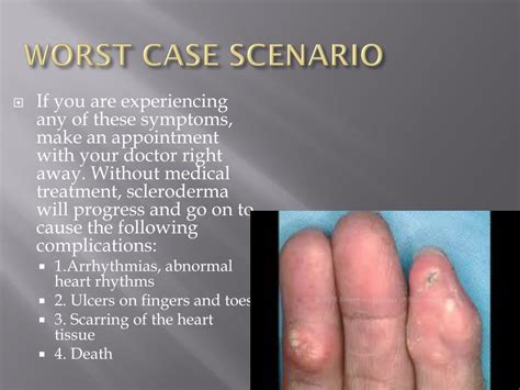 Ppt Crest Syndrome Limited Scleroderma Powerpoint Presentation Free Download Id 2847033