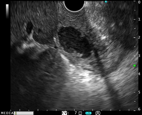 Duodenal Wall Cyst As Seen By Endoscopic Ultrasound Download Scientific Diagram