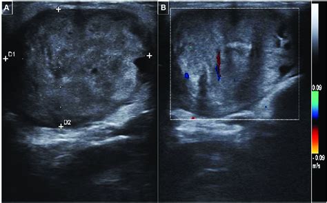 Extraskeletal Ewing Sarcoma A Ultrasound Showing Heterogeneous