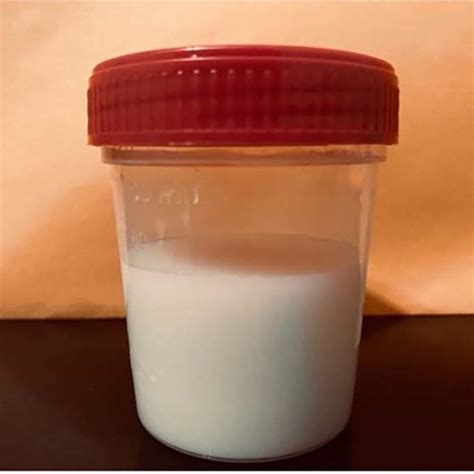 Colonoscopy Shows Large Necrotic Obstructive Ulcerated Friable Mass