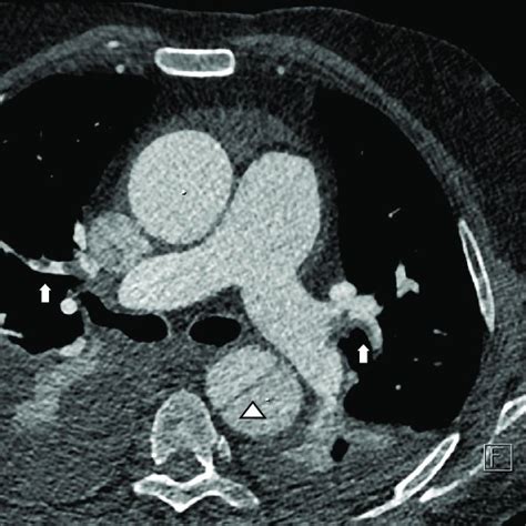 Computed Tomography Angiography Image Showing Acute Pulmonary Embolism Download Scientific