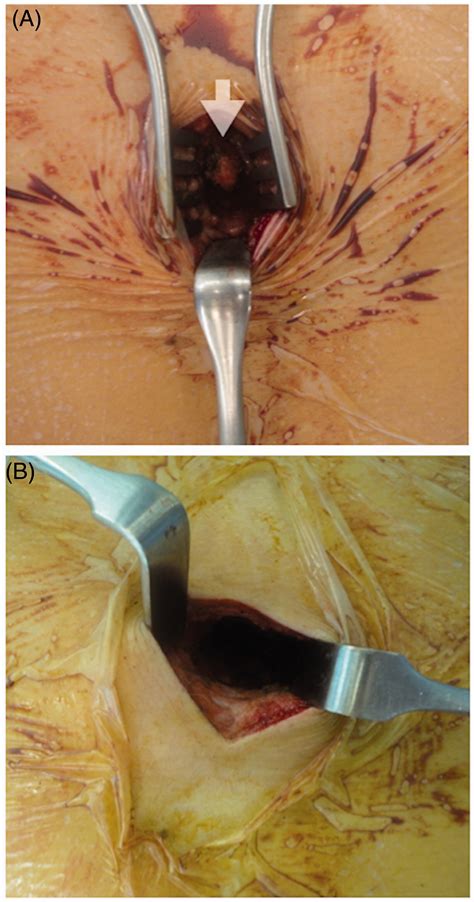 Xiphoidectomy Procedure Code Three Dimensional Surface Imaging In