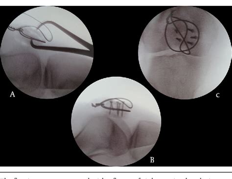 Figure 2 From Split Fracture A Complication Of Cerclage Wiring Of Acute Patellar Fracture