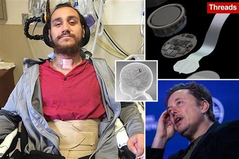 Elon Musks Neuralink Chip Malfunctions In First In Human Brain Implant