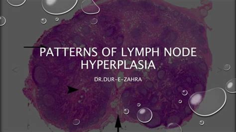 Patterns Of Lymph Node Hyperplasia Pptx