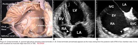 Crista Terminalis Mri