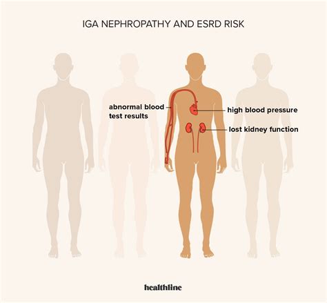 Risikofaktorer Og årsaker Til Iga Nefropati Med Norge