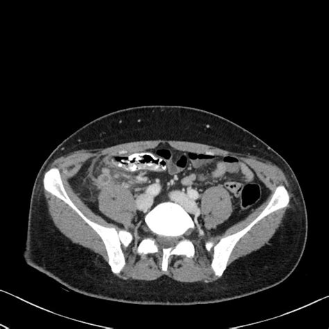 Radiopaedia Case Perforated Appendicitis Retrocecal Appendix Id
