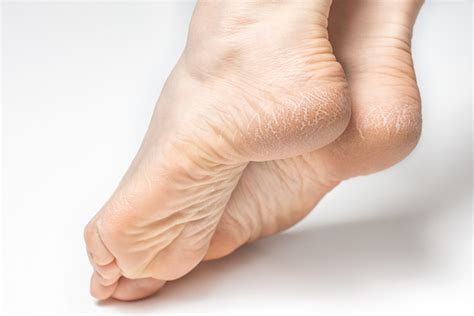 Crusty Feet