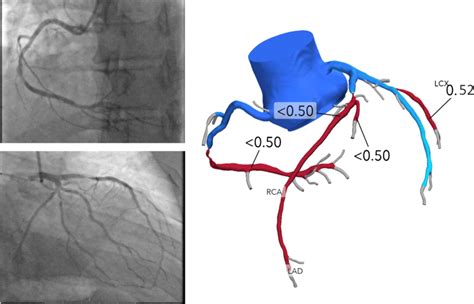 Case Example Of A 45 Year Old Gentleman With Severe Stenosis In The Lad Download Scientific