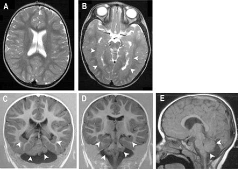 Periventricular Nodular Heterotopia Semantic Scholar