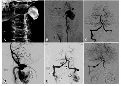 A 38 Year Old Man With A Left Pca Territory Embolic Infarct Was Found