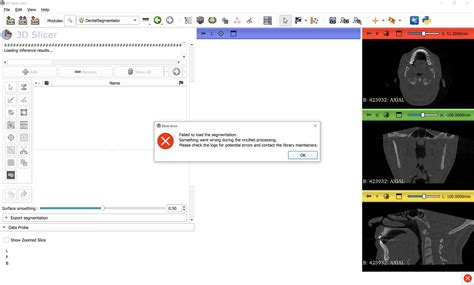 New Extension Dentalsegmentator For Automatic Dental Ct And Cbct
