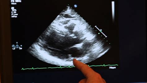 Echocardiogram Demonstration Youtube