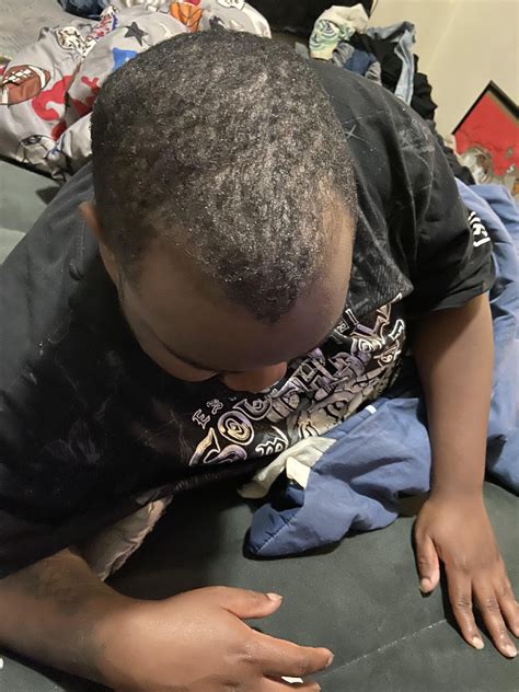 5 Months With Minoxidil For Widows Peak Thinning Hair After Bleaching