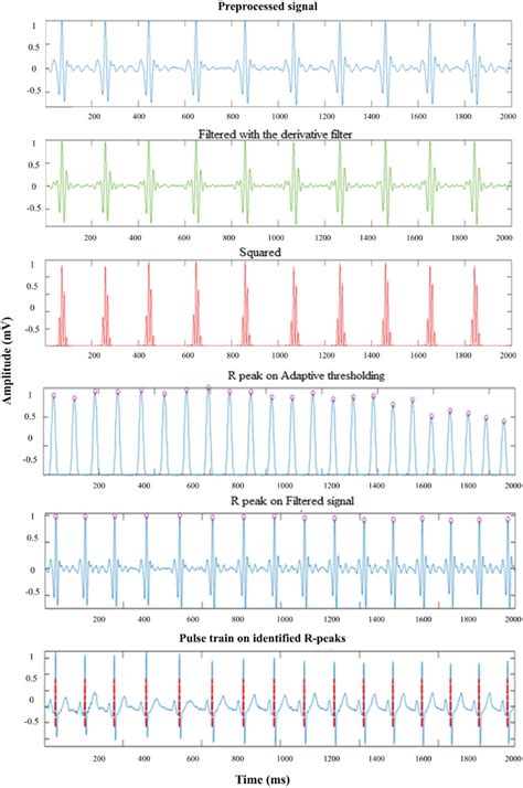 Qrs Peaks Detection Top To Bottom Band Pass Filtered Signal Download Scientific Diagram