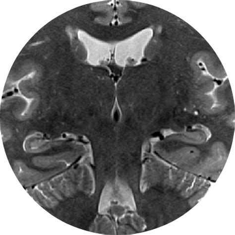 Hippocampal Subfields Group Youtube