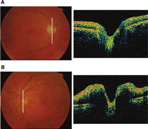 A Fundus Photograph And Corresponding Vertical Cross Sectional Optic