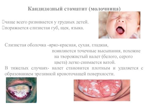 Кандидозы Классификация Лечение