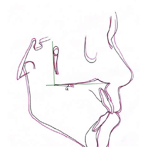 Superimposition Black Cephalometric Tracing 1 And C1 Centroid Download Scientific Diagram