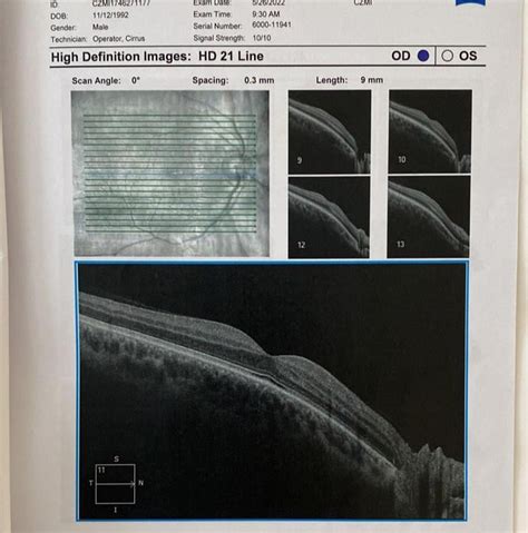 31 M Lattice Degeneration Management R Ophthalmology