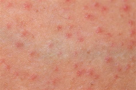 Itchy Red Spots On Scalp