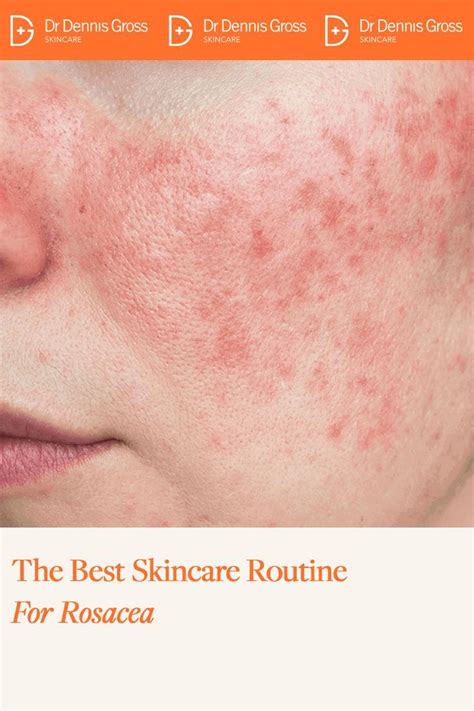 Skincare For Rosacea Rosacea Skincare Tips Artofit