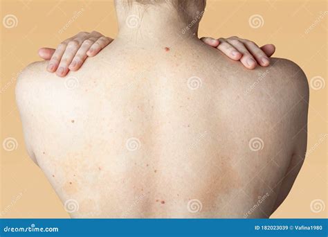 Allergic Dermatitis On The Skin Of A Woman`s Back Skin Disease