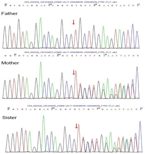 A Novel Mutation In The Kcnh2 Gene Associatedwith Long Qt Syndrome A