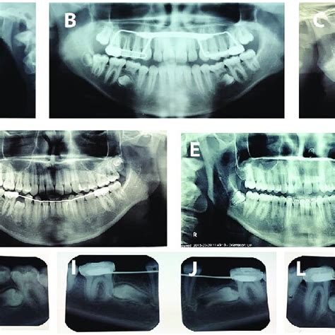 Panoramic And Periapical Radiographies Monitoring Of Premolar Eruption