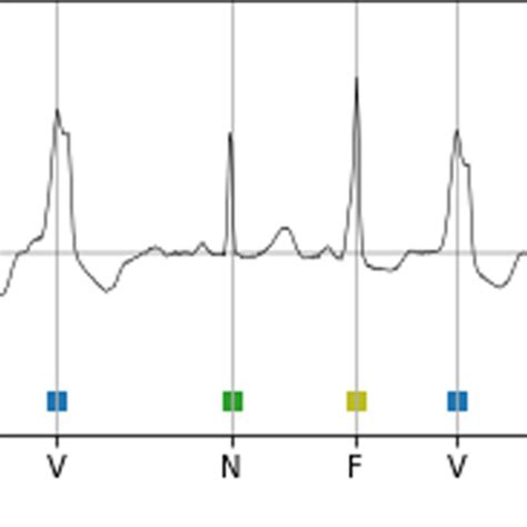 Ecg Lead 2 Dataset Physionet Open Access Kaggle