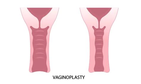 Vaginoplasty Treatment Procedure Types And Recovery Ck Birla Hospital