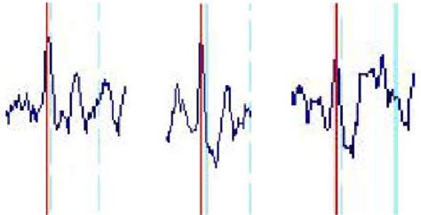 Figure 1 From Deep Learning For Epileptic Spike Detection Semantic Scholar