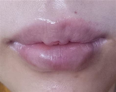 의사에게 물어보세요 오늘 입술필러 맞고 강남언니 1등 성형수술and피부시술 정보앱