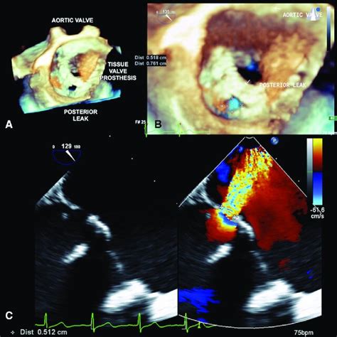 Echocardiographic Views Of The Mitral Valve Of A Patient With Previous