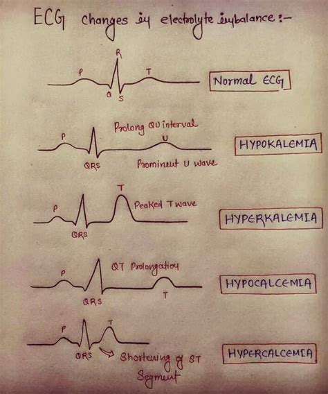 Hypocalcemia Ecg