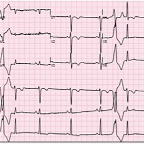 Abnormal Inverted T Waves Noted Across Anterior Precordial Leads V1 3 Download Scientific